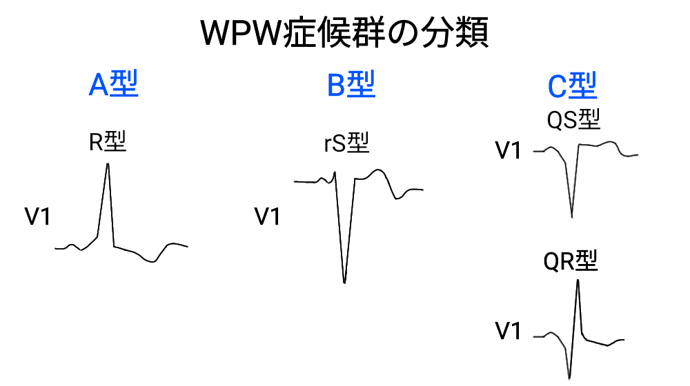 わかりやすい心電図の説明 ⑤PR PR時間 WPW症候群 LGL症候群 | 医師の心電図ブログ