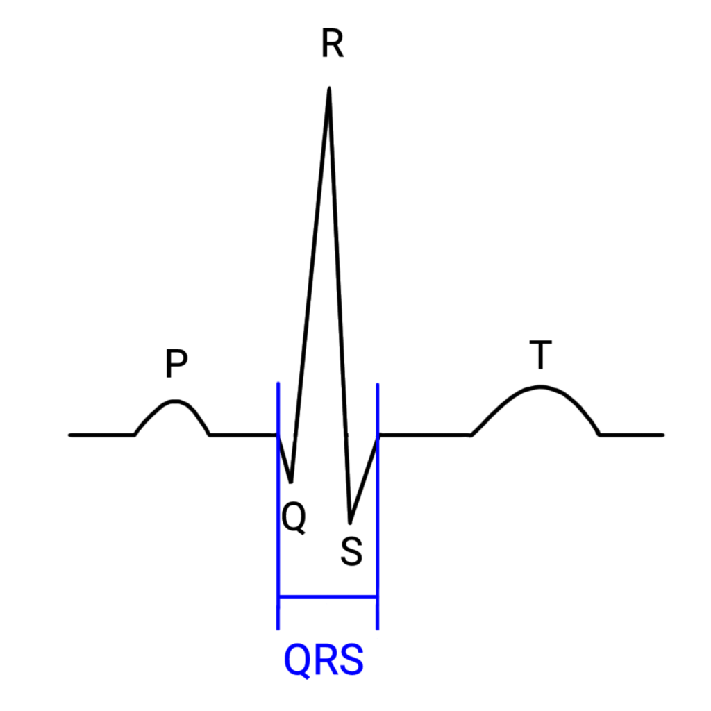 わかりやすい心電図の説明 ⑧QRS R波 心室肥大 S波 | 医師の心電図ブログ