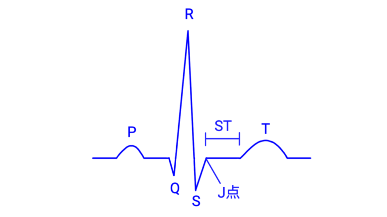 わかりやすい心電図の説明 ⑧ST、J点、J波、ST上昇、STが上昇する疾患です。 | 医師の心電図ブログ