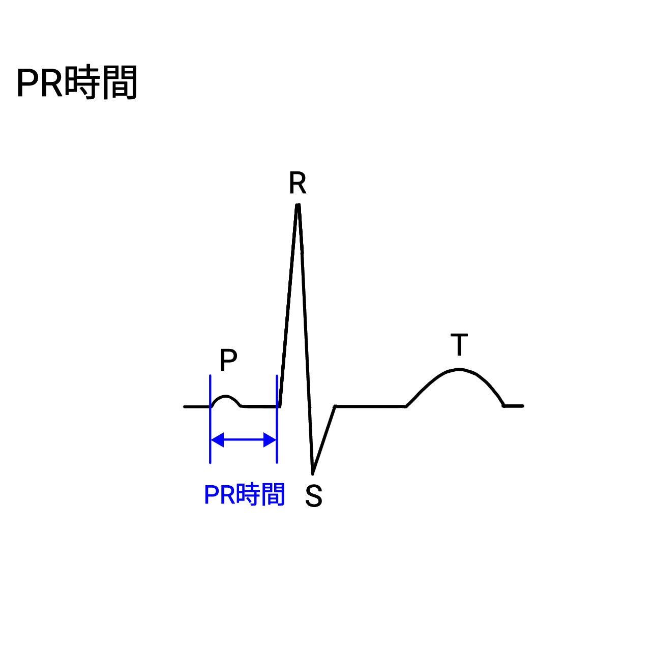 わかりやすい心電図の説明 ⑤PR PR時間 WPW症候群 LGL症候群 | 医師の心電図ブログ
