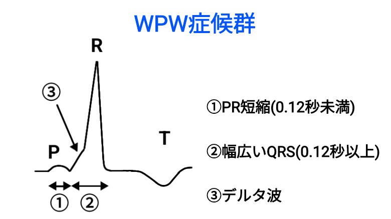 わかりやすい心電図の説明 ⑤PR PR時間 WPW症候群 LGL症候群 | 医師の心電図ブログ