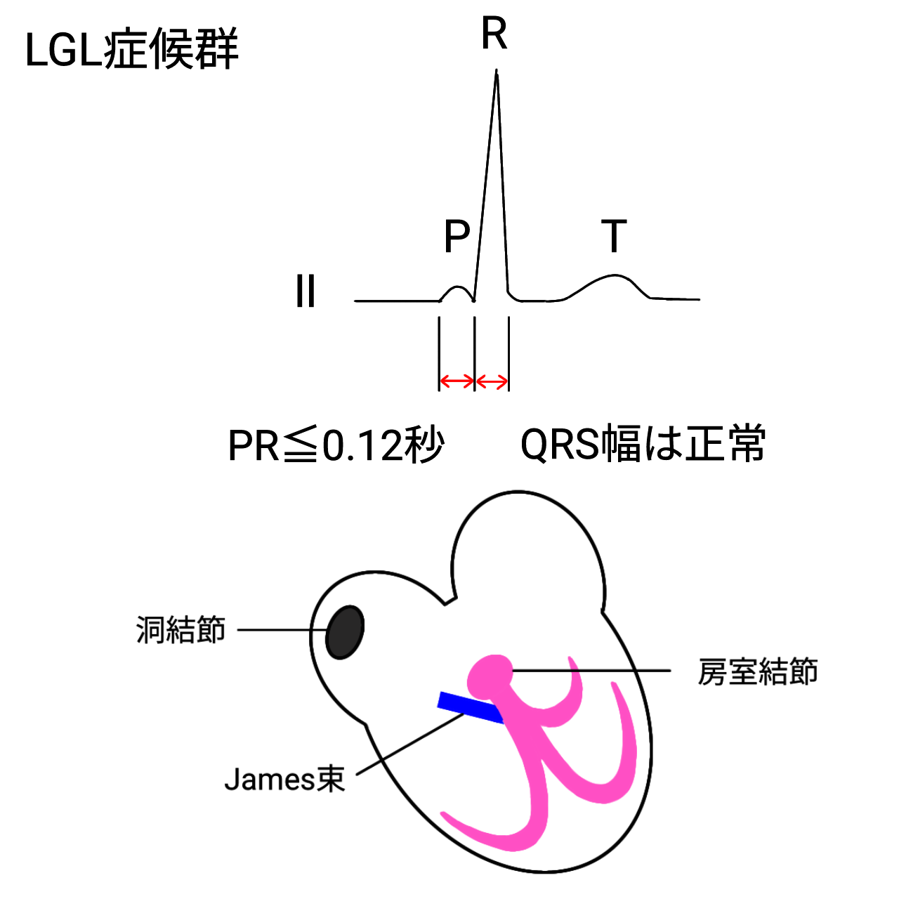 わかりやすい心電図の説明 ⑤PR PR時間 WPW症候群 LGL症候群 | 医師の心電図ブログ