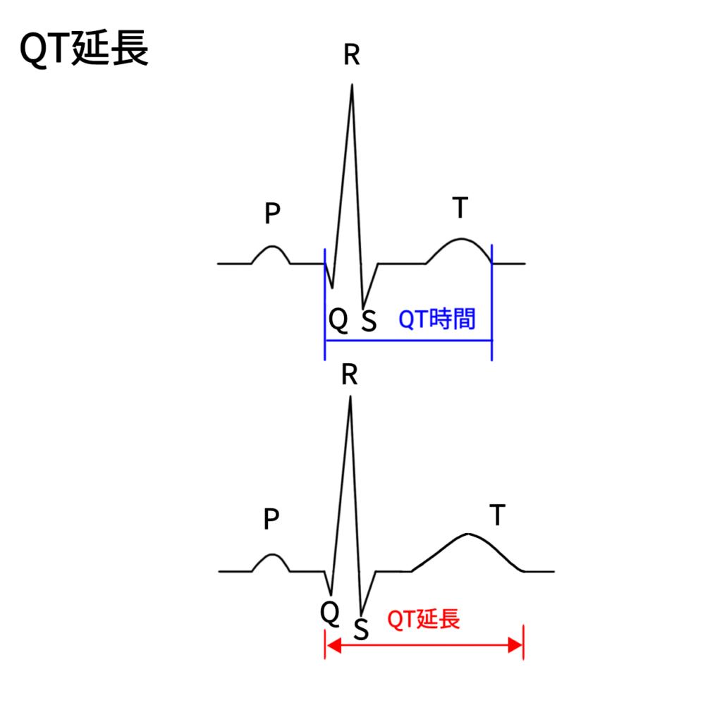 心電図をわかりやすく説明 ⑬QT時間 TdP U波 | 医師の心電図ブログ