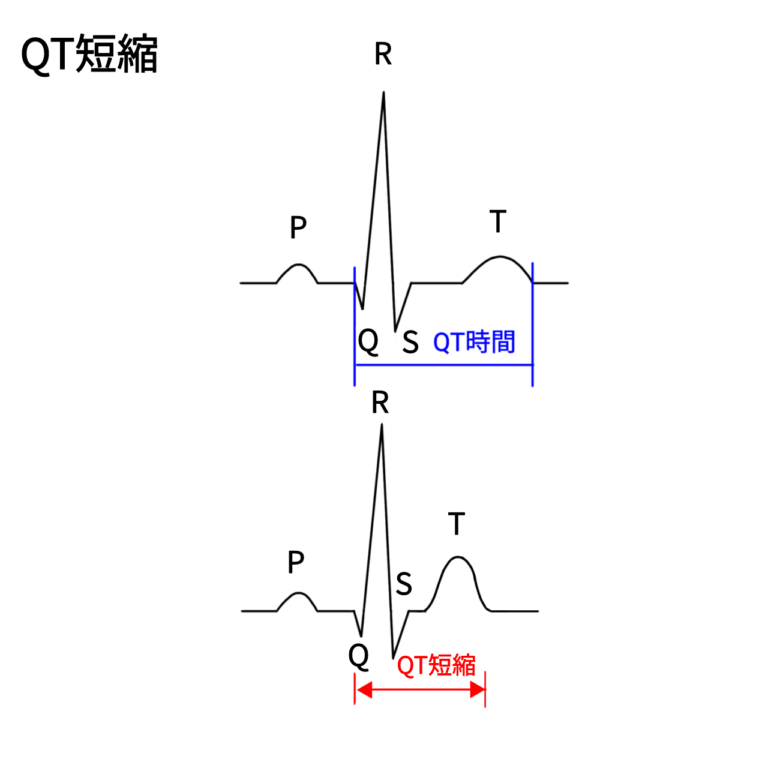 心電図をわかりやすく説明 ⑬QT時間 TdP U波 | 医師の心電図ブログ